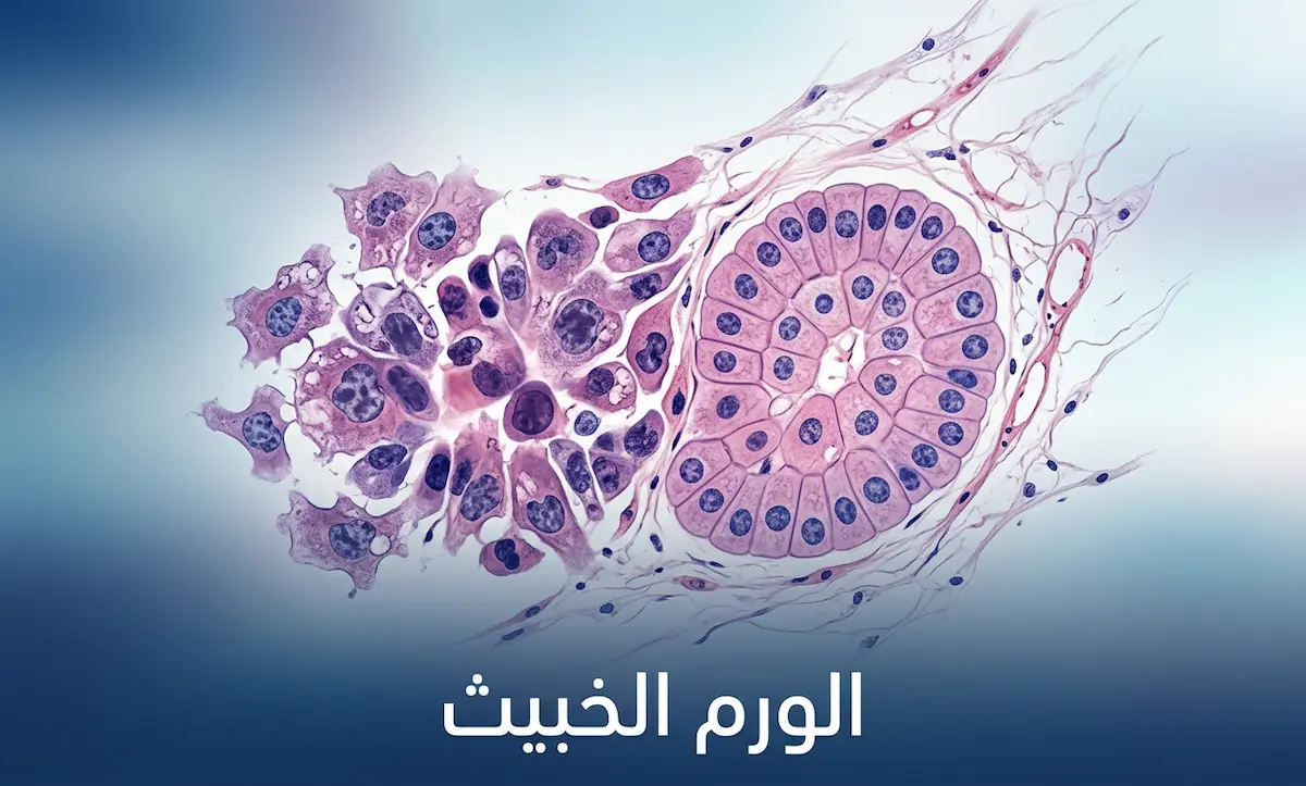 الورم الخبيث: الدليل الطبي الشامل (الأعراض، المراحل، ونسب الشفاء ...